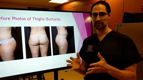 Most Asked Questions About Our Brazilian Butt Lift Bbl Procedure Video Realself
