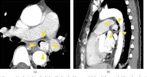 Figure 1 From Tracheal Mucoepidermoid Carcinoma Mimicking Deteriorated