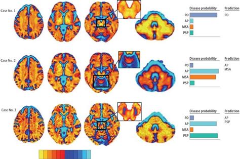 Hmn 2025 How Ai Driven Mri Evaluation Improves Accuracy In Distinguishing Parkinsonian Problems