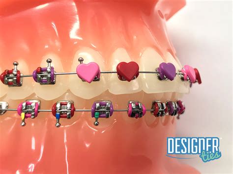 Retainer Designs Like Brace Pink