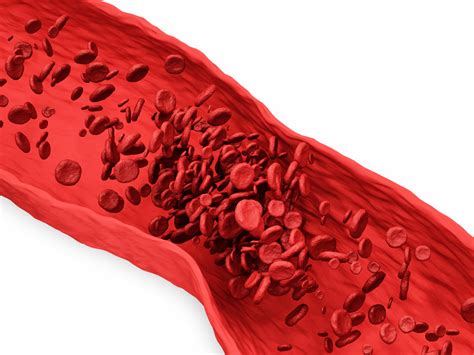 Aafp Endorses Guidelines On Venous Thromboembolism Dx