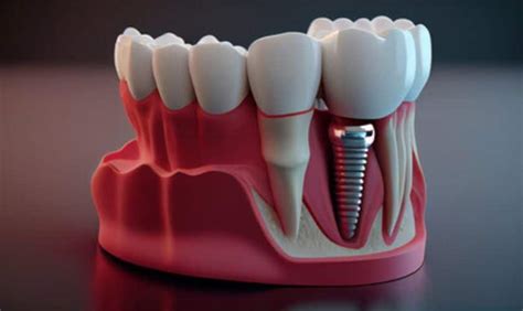 Choosing Between Titanium And Zirconia Dental Implants