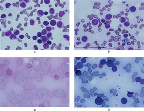 A Peripheral Blood Smear B Bone Marrow Smear Stained By May