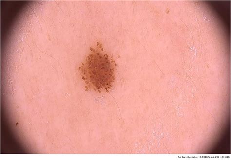 Congenital Nevus Melanoma