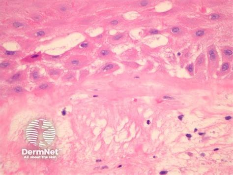 Radiation Dermatitis Pathology Image