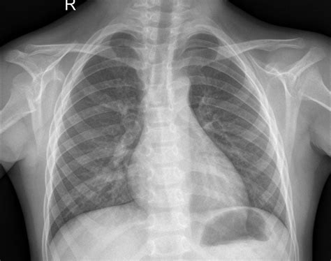 Airespucrschest Xray · Datasets At Hugging Face