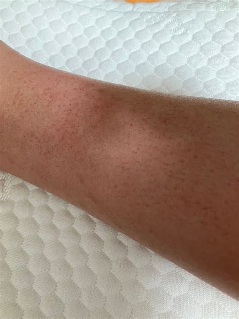 다리에 붉은반점 내공 77 지식in