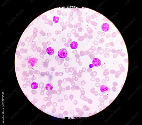 Acute Myeloid Leukemia Aml Is A Type Of Blood Cancer Microscopic