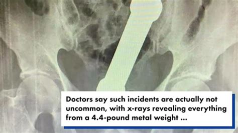 Man With Wwi Explosive Lodged In His Rectum Sparks Bomb Scare Hospital