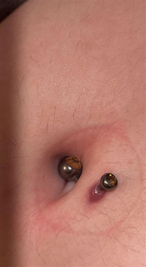 Belly Button Piercing Bump Rejection Tw Kinda Gross Lol Rpiercing