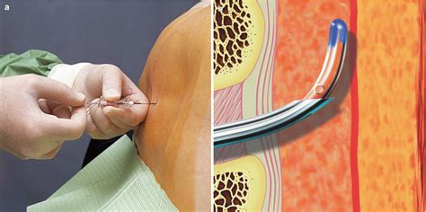 Thoracic Epidural Anesthesia And Epidural Hematoma Lu