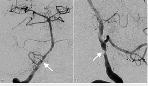 Conventional Angiogram Two Years Post Stent Placement Conventional