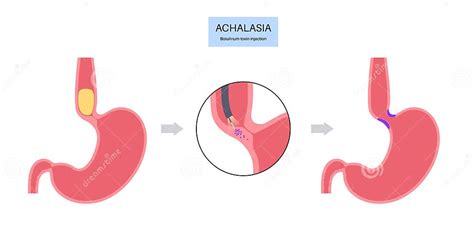 Esophageal Botulinum Toxin Injection Stock Illustration Illustration