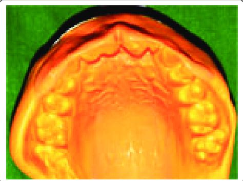 Polyvinyl Silicone Impression Made Over Interim Prosthesis Download Scientific Diagram