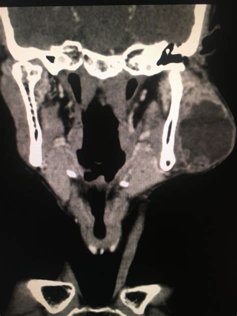 Adenoid Cystic Carcinoma Of Left Parotid Gland Sfondi Per Telefono