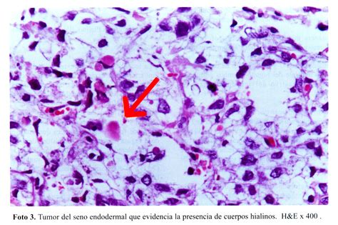 Tumor Del Seno Endodermal Extragonadal En La Infancia Reporte De Dos Casos