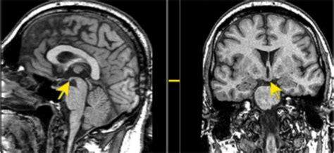 Temporal Lobe Flashcards Quizlet