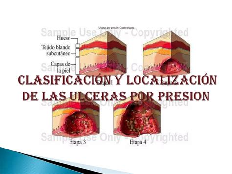 Ulceras Por Por Presion Pptx