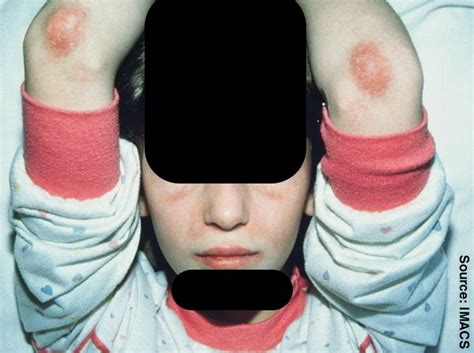 Juvenile Dermatomyositis Alchetron The Free Social Encyclopedia