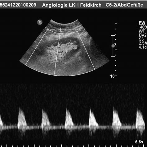 Doppler Signal Of The Distal Segmental Artery Download Scientific