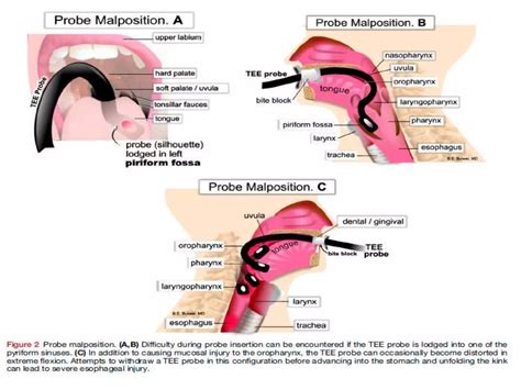 Transesophageal Echocardiographytee Ppt