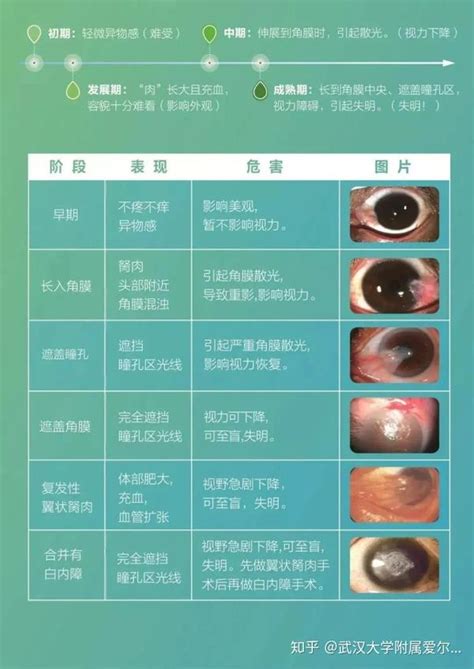 眼睛突然长出小翅膀要注意这是一种翼状胬肉眼病 知乎
