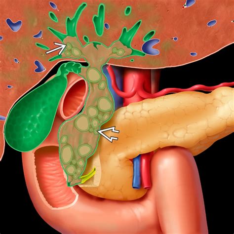 Recurrent Pyogenic Cholangitis Radiology Key