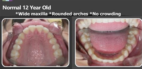 Maxillary Skeletal Expansion Mse Dentist Arlington Va