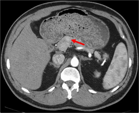 Central pancreatectomy with pancreaticogastrostomy reconstruction: A brief report and video ...