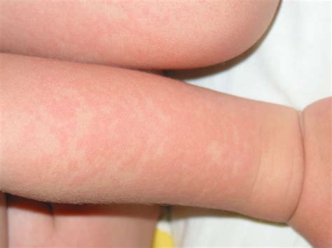 Fifth Disease 10 Symptoms Of Fifth Disease