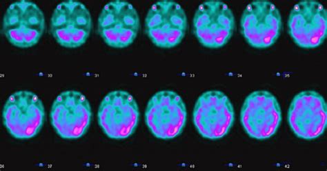 Spect cerebral qué es y cómo funciona este método de neuroimagen