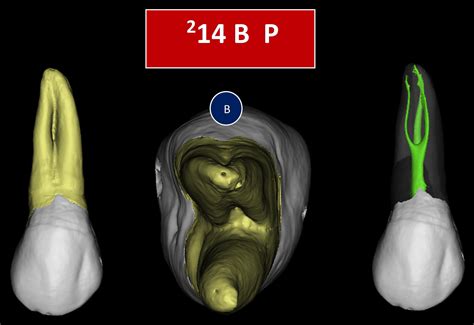 Application Of A New System For Classifying Root And Canal Anatomy In