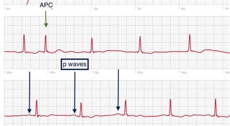 Premature Atrial Contraction
