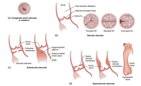 Figure Types Of Left Ventricular Outflow Tract Obstruction
