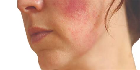 Mill Sarcoma Putty علاج التهاب الجلد Protest Expired Lack