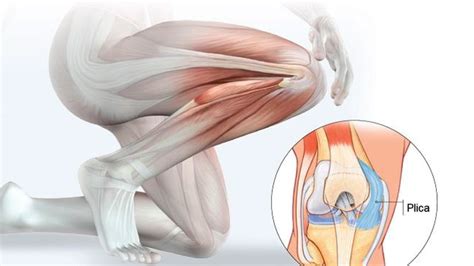 Understanding Plica Syndrome Treatment And Solutions Osteomag