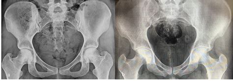 Preoperative A And B Postoperative Radiography Download