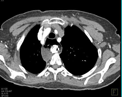 Dilated Esophagus With Retained Food And Contrast Esophagus Case