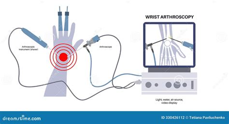 Wrist Arthroscopy Surgery Stock Vector Illustration Of Wrist 330426112