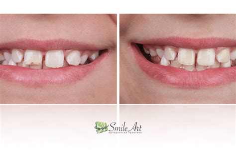 Бондинг Архив ортодонтска практика Smile Art Лечение на криви зъ