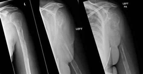 What Is Glass Bone Disease