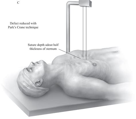 Figure 1 From The Minimally Invasive Repair Of Pectus Excavatum