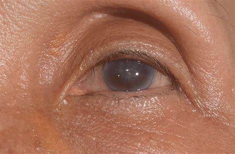 Periorbital Edema All About Vision