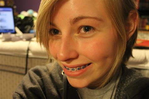 Braces By Oreolovers77 On Deviantart Braces By Oreolovers77 On Deviantart