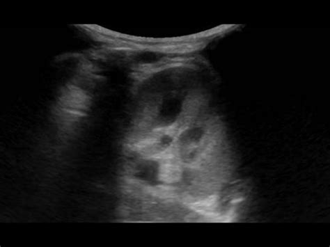 Abdomen And Retroperitoneum 1 2 Gallbladder And Bile Ducts Case 1 2