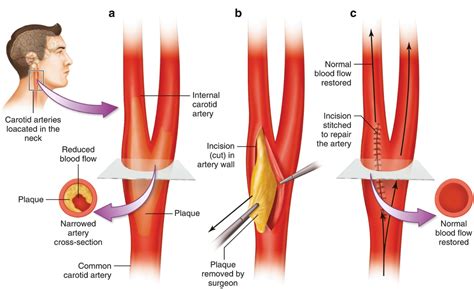 Monitoring For Carotid Endarterectomy Neupsy Key
