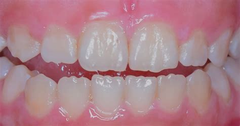 Jagged Teeth Causes And 6 Ways To Fix Them Longevita Dental