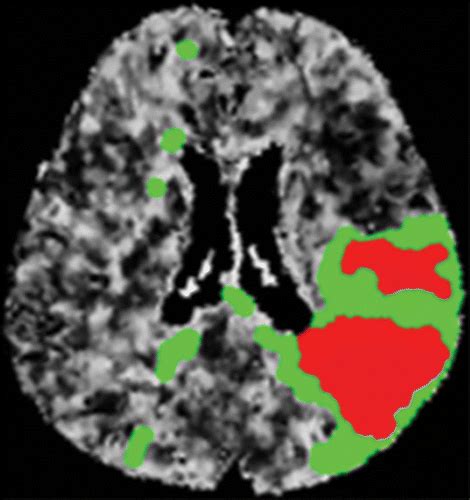 Collateral Status At Single Phase And Multiphase Ct Angiography Versus Ct Perfusion For Outcome