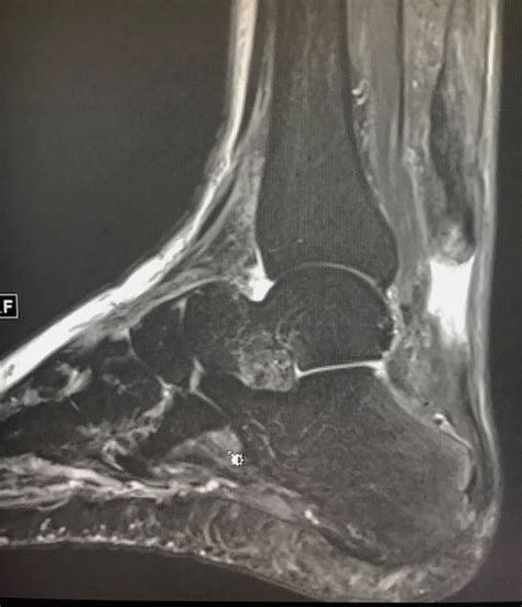 Achilles Tendon Tear Mri And Abnormal X Ray Premier Radiology Services