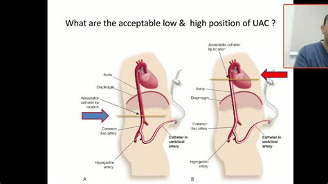 Case 15 How To Differentiate Between Uav And Uvc Youtube